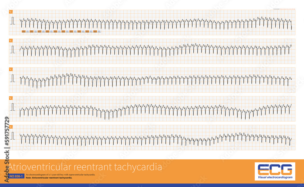 A 1 year old Boy With Recurrent Supraventricular Tachycardia a-1-year-old-boy-with-recurrent-supraventricular-tachycardia