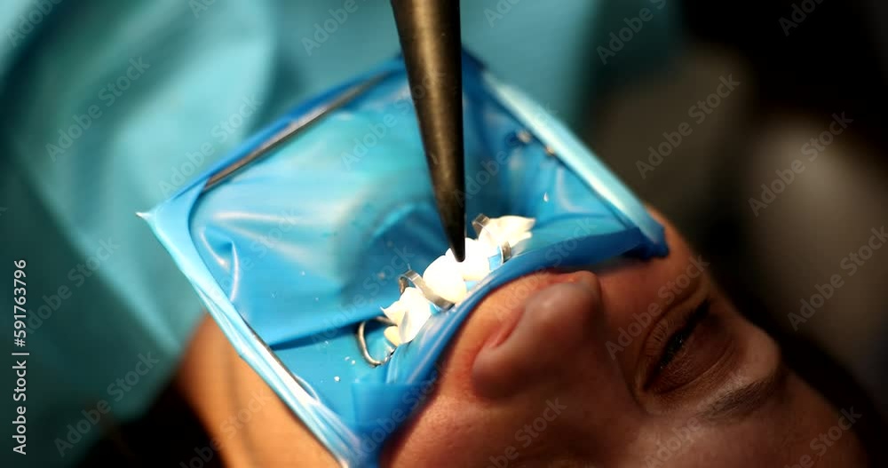Dentist processes teeth of female patient with airstream to get rid of ...