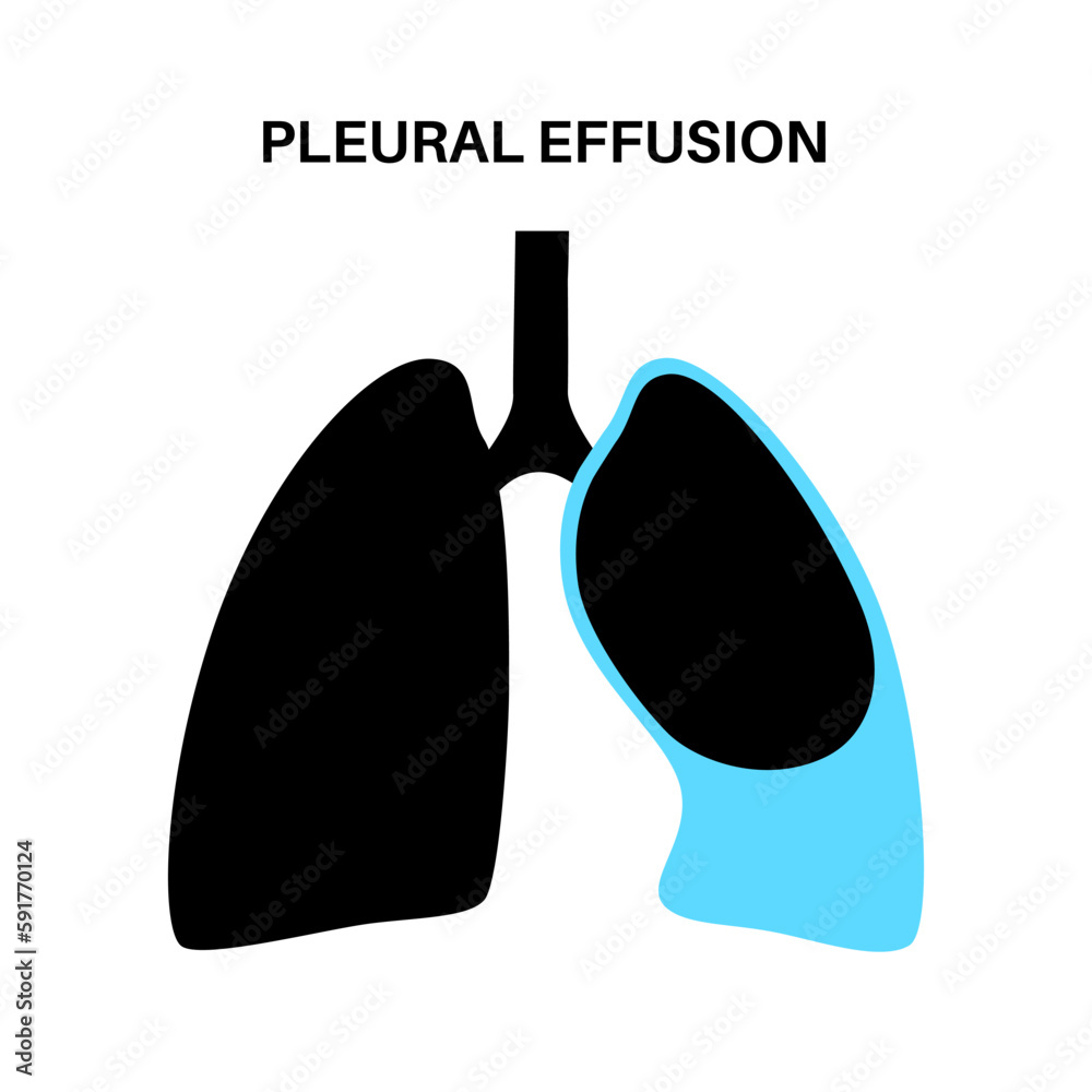 Pleural effusion poster Stock Vector | Adobe Stock