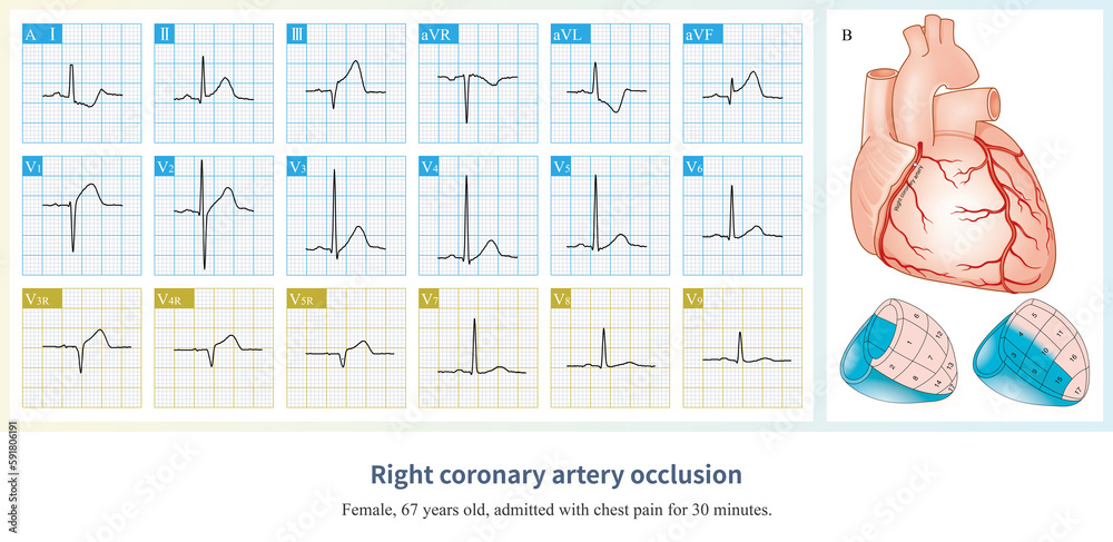 Acute occlusion of the proximal to middle segment of the right coronary ...