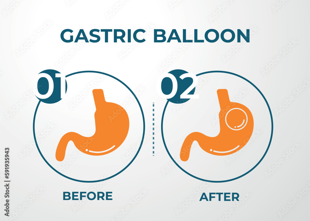 Stomach Endoscopy Gastric Balloon Inside a Stomach weight loss surgery ...