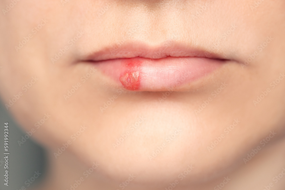 Foto de herpes virus affects lips, rash and blisters on lips in women ...