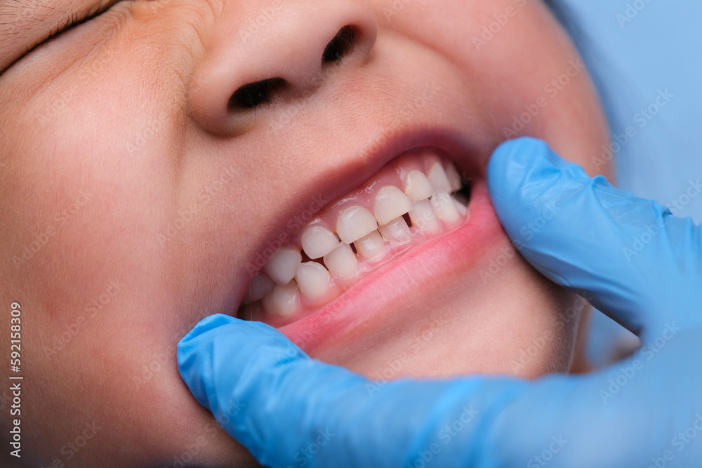Close-up inside the oral cavity of a healthy child with beautiful rows ...
