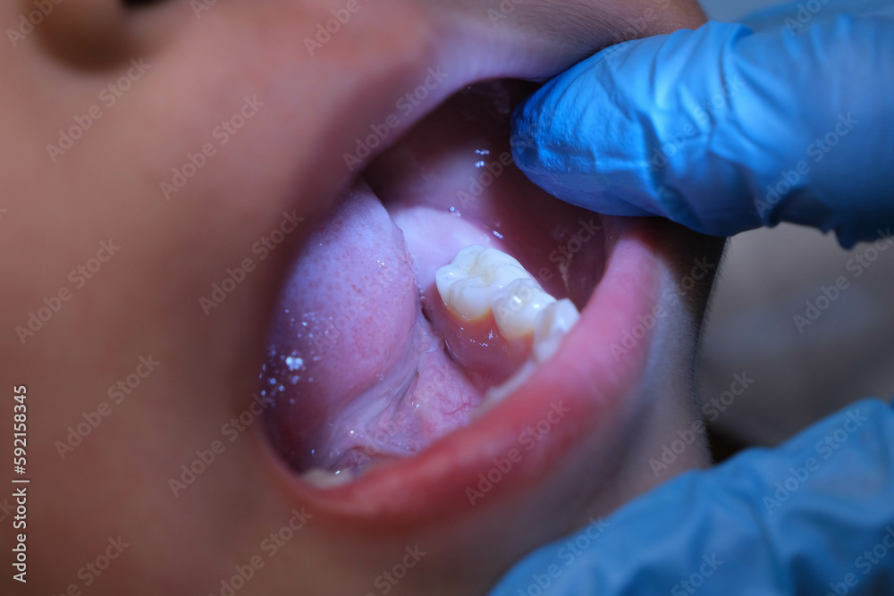 Close-up inside the oral cavity of a healthy child with beautiful rows ...