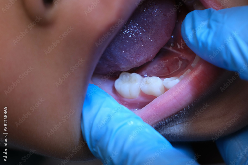 Close-up inside the oral cavity of a healthy child with beautiful rows ...