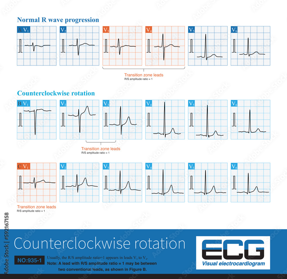 Counterclockwise rotation is a common electrocardiogram phenomenon ...