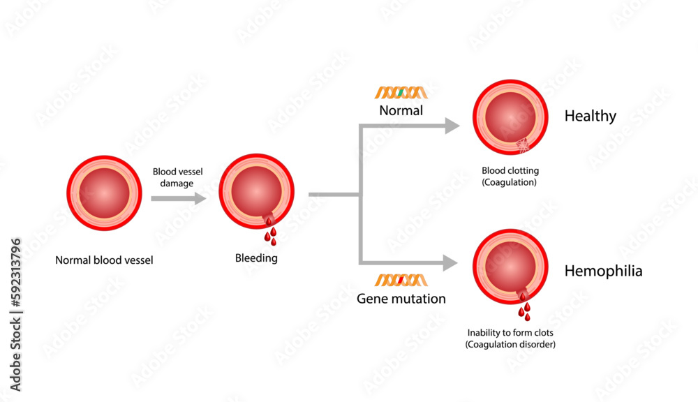Hemophilia, a bleeding disorder that slows the blood clotting. Haemophilia (Coagulation disorder ...
