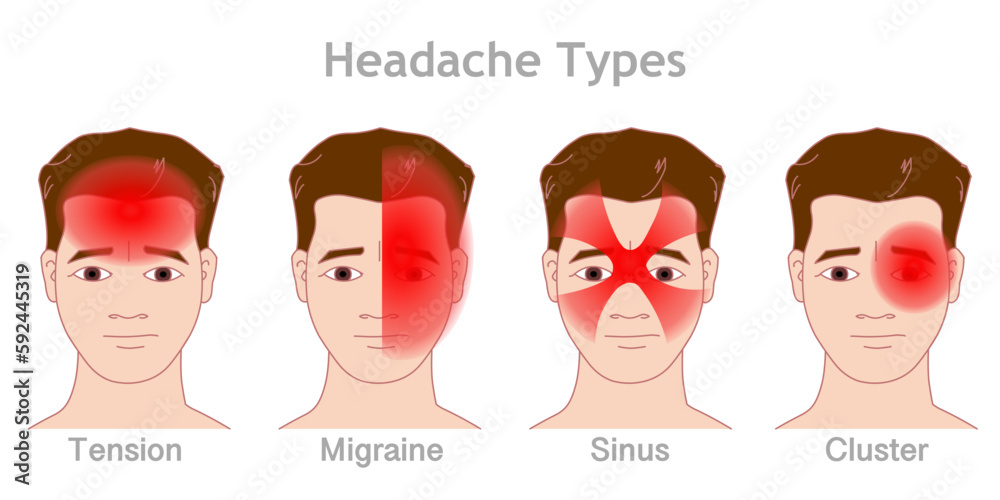 Headache types. Head pain. Tension, migraine sinus, cluster. Man, boy face gradient red location ...