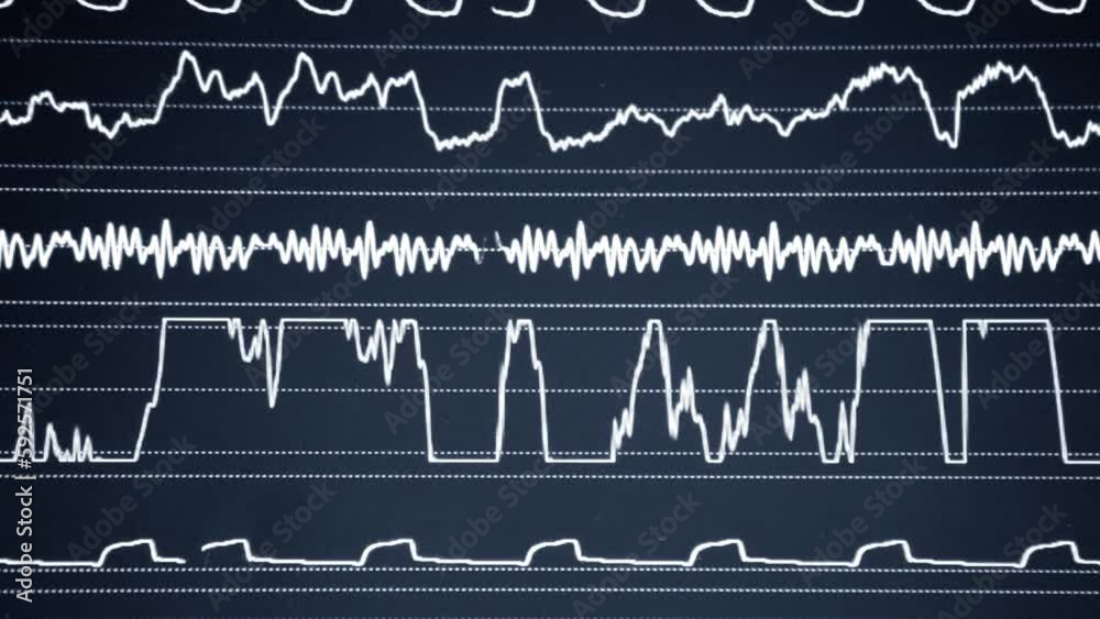 Modern patient monitor. Electronic Health Monitor displaying medical ...