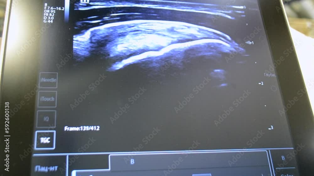 Ultrasound on monitor. Ultrasound image on computer monitor screen ...