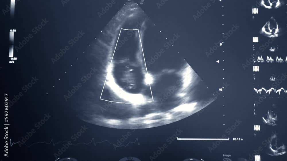 Ultrasound on monitor. Ultrasound image on computer monitor screen ...