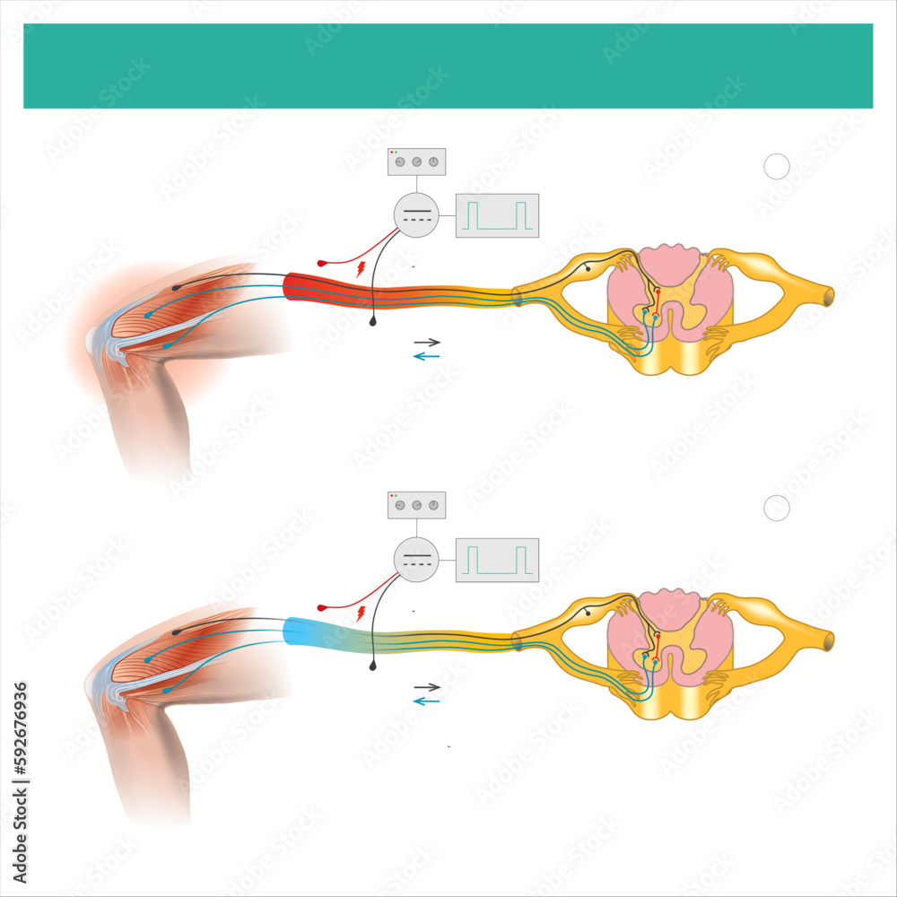 Epidural Electrical Stimulation. Muscle pain symptom in the leg area ...