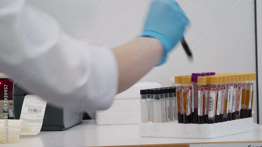 Doctor Sticks Barcodes On Blood Analysis Samples. Inserting Blood ...