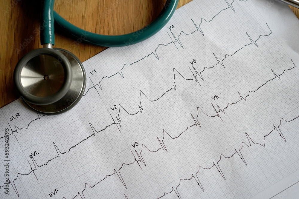 stethoscope on a real emergency ECG with a occlusive anterior ...