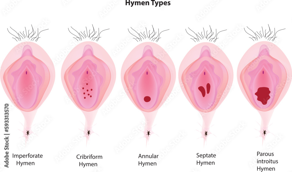 Hymen Types Stock Vector Adobe Stock Hymen Types Stock Vector Adobe Stock