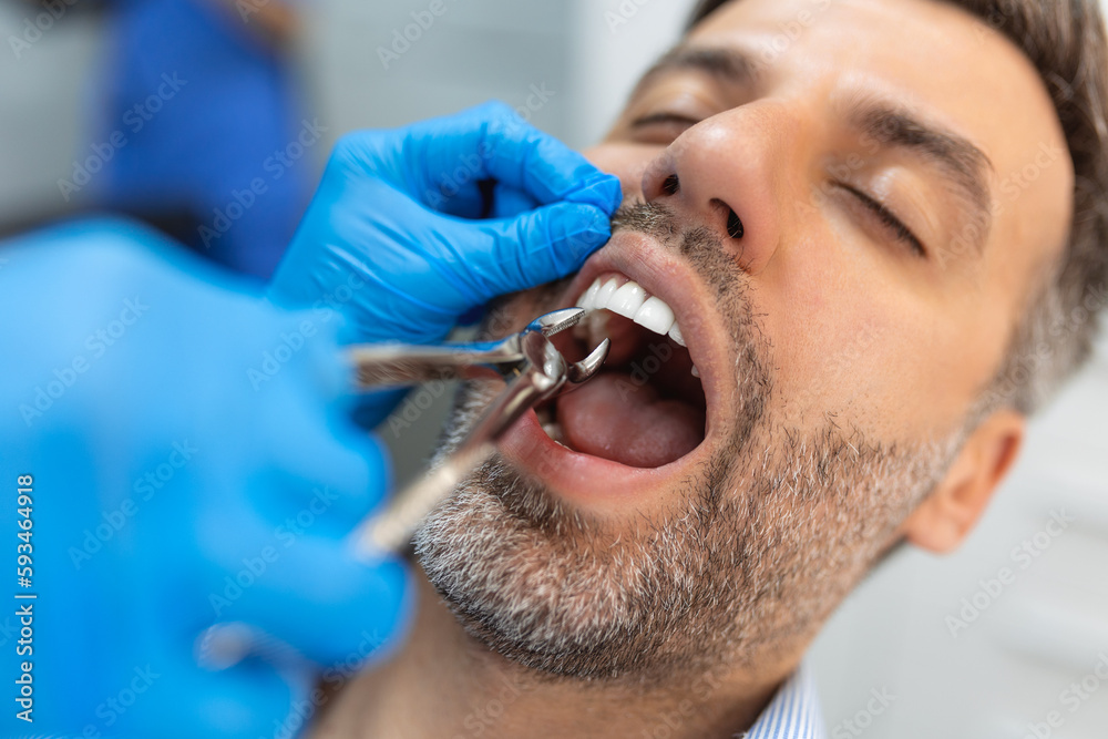 Foto de Surgeon removing the tooth. Dentist using surgical pliers to ...