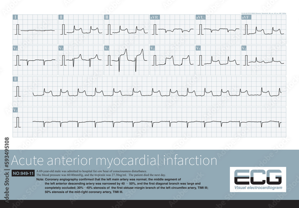 A 69 year old patient with acute myocardial infarction, whose ...