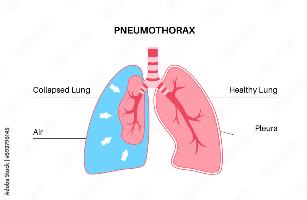 Pneumothorax anatomical poster Stock Vector | Adobe Stock