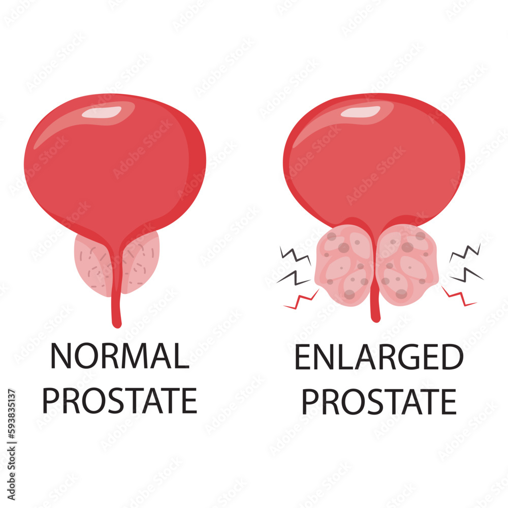 Normal prostate and benign pro-static hyperplasia. Bladder surgery ...