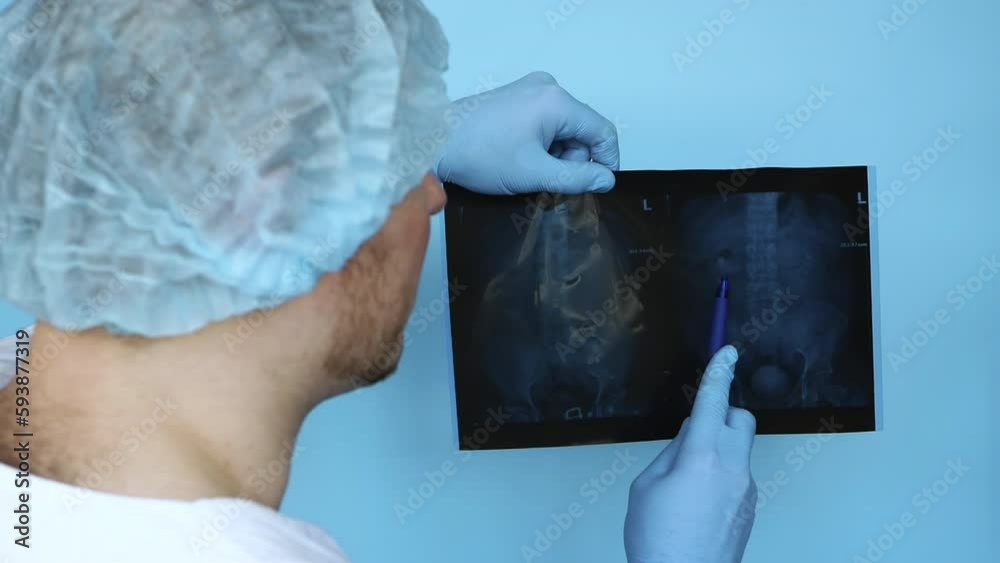 X-ray of a calculus in the kidney 8 mm. Stone in the ureter on x-ray. X ...