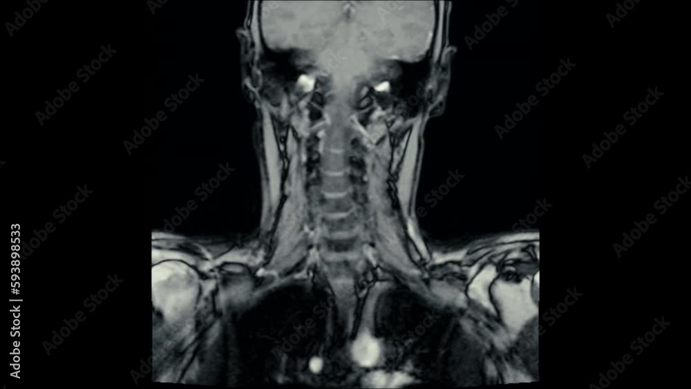 Magnetic Resonance images ( MRI ) of cervical spine sagittal. C5 ,C6 ...