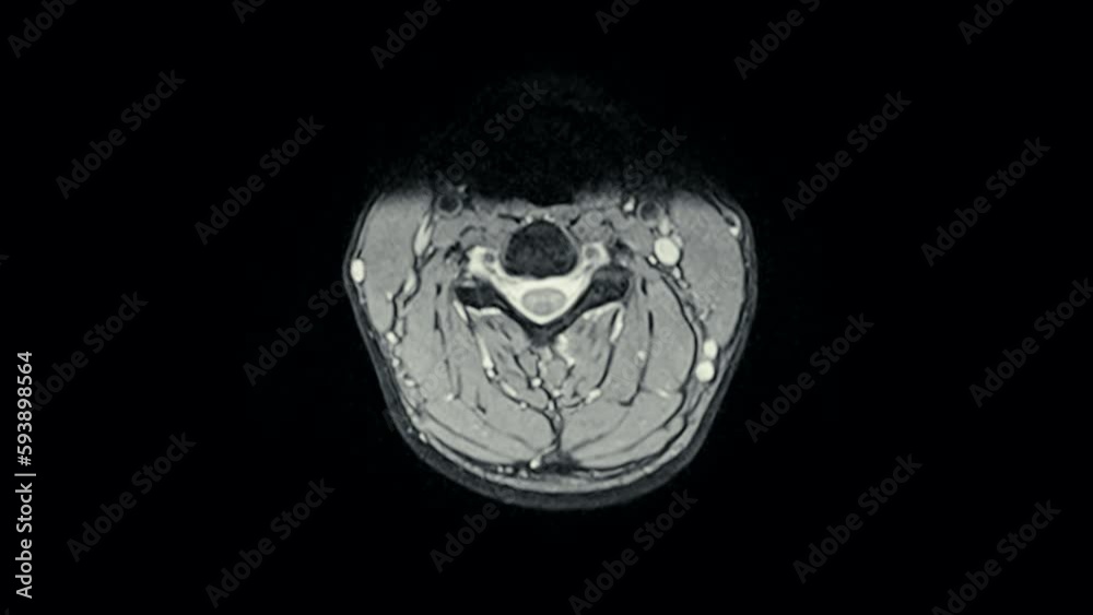 Magnetic Resonance images ( MRI ) of cervical spine sagittal. C5 ,C6 ...