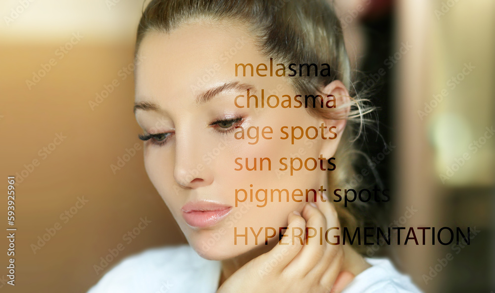 Dark spots, freckles,hyperpigmentation(melasma or chloasma),concept ...