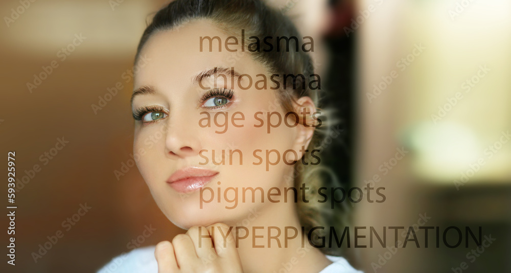 Dark spots, freckles,hyperpigmentation(melasma or chloasma),concept ...