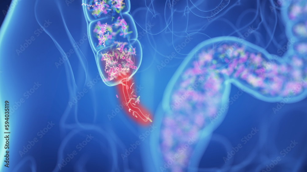 3d medical illustration of the microbiome of an inflamed colon Stock ...