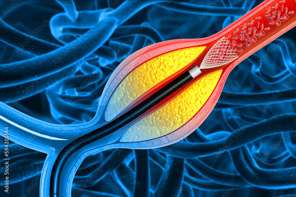 Balloon angioplasty procedure to expanded artery for blood flow ...