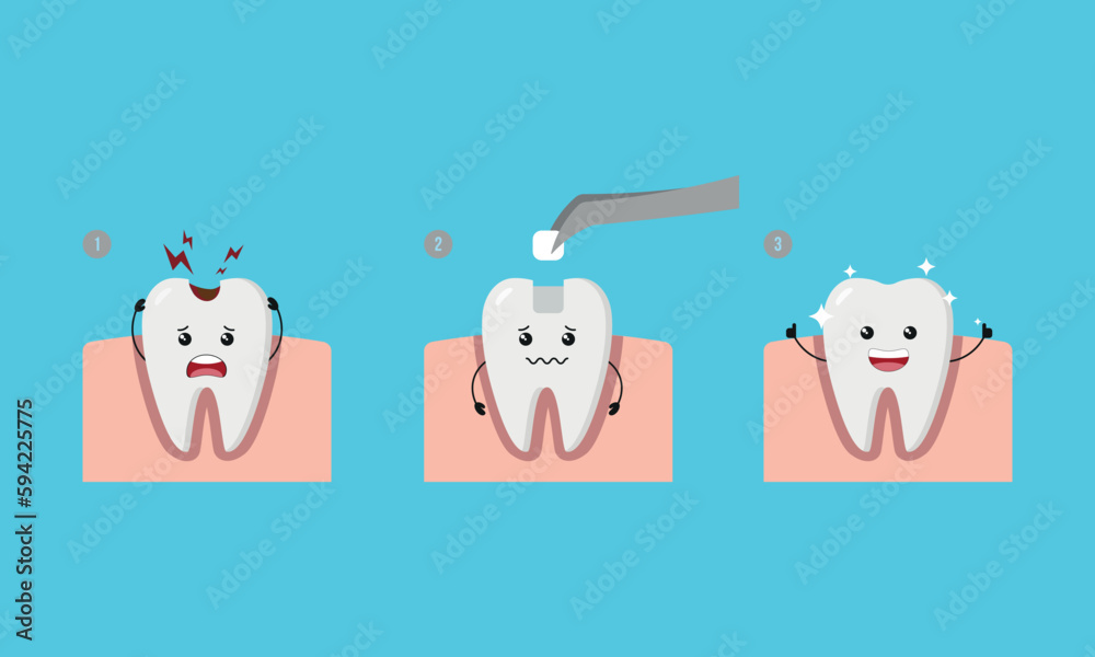 Dental Step of restoring cavity tooth by filling tooth illustration ...