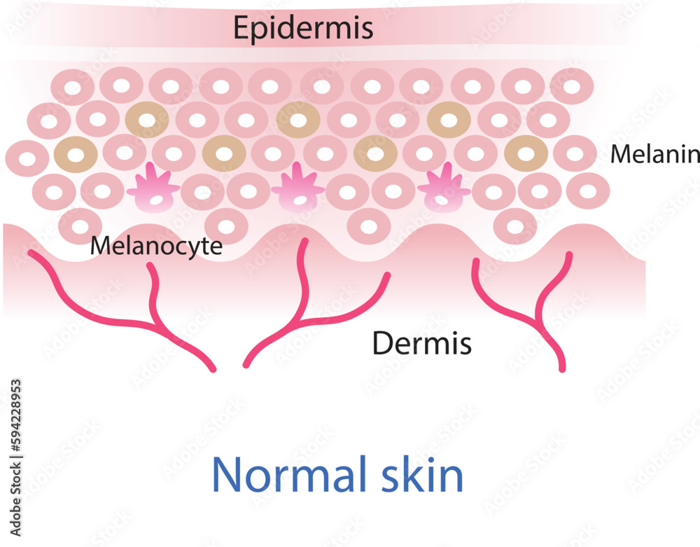Normal skin layer vector, melanocyte, melanin, melanogenesis vector on ...