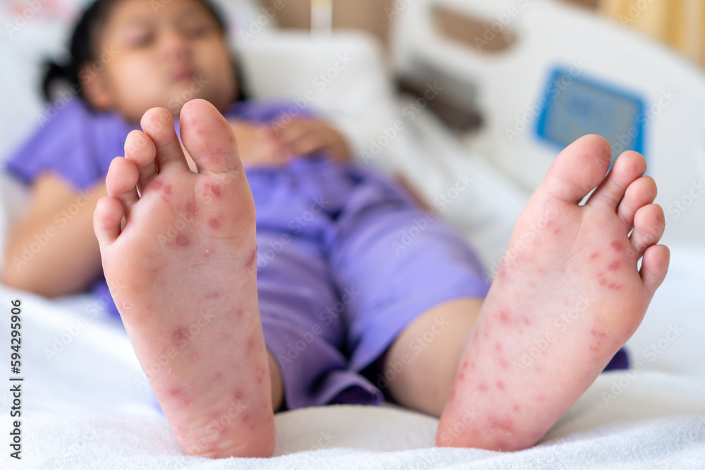 Enterovirus foot red spots blisters on the skin of on the body of a ...