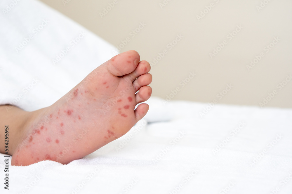 Enterovirus foot red spots blisters on the skin of on the body of a ...