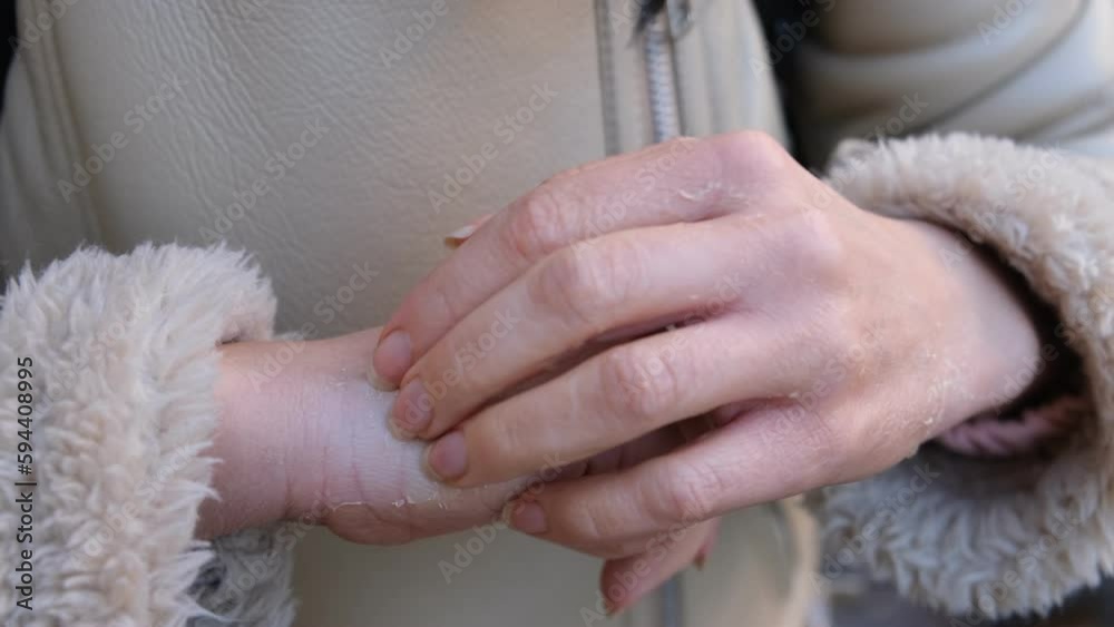 A young woman itches her palms with peeling skin. Causes of itchy skin ...