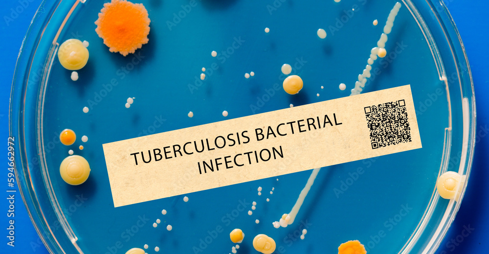 Tuberculosis - Bacterial infection that usually affects the lungs and ...