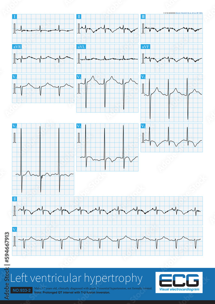 The typical ECG for left ventricular hypertrophy is left ventricular ...