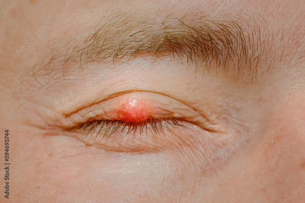 Eyelid sickness. Demodicosis mite diseas, demodex. Chalazion on eyelid ...