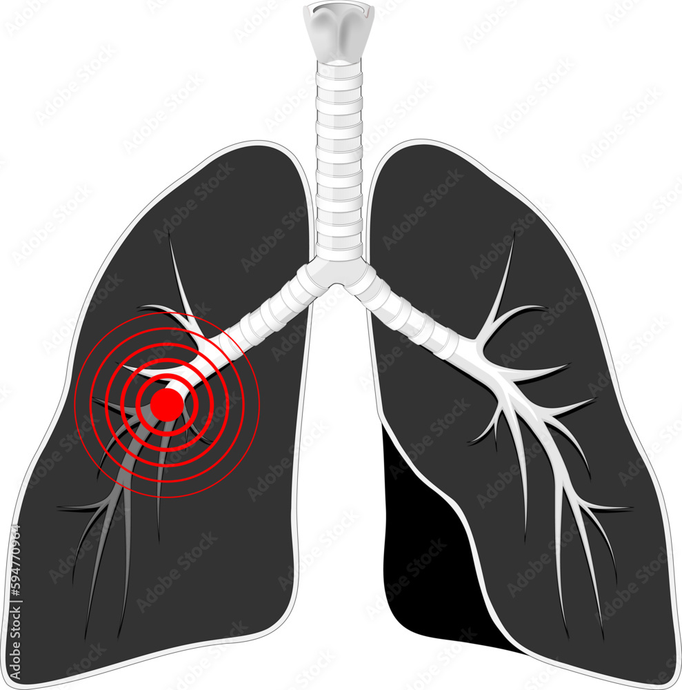 Lungs disease. Black lungs with bronchi on white background. Stock ...