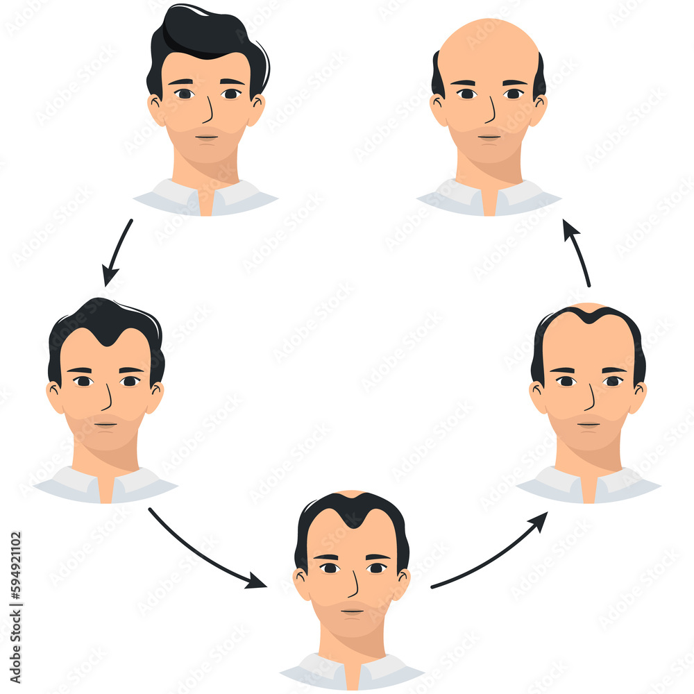 Hair loss stages, male androgenetic alopecia, steps of baldness flat ...