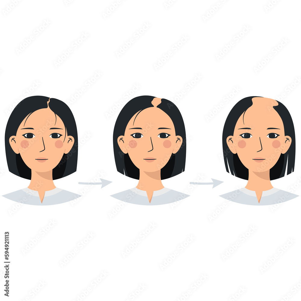 Steps of baldness infographic with woman head, hair loss stages, female ...