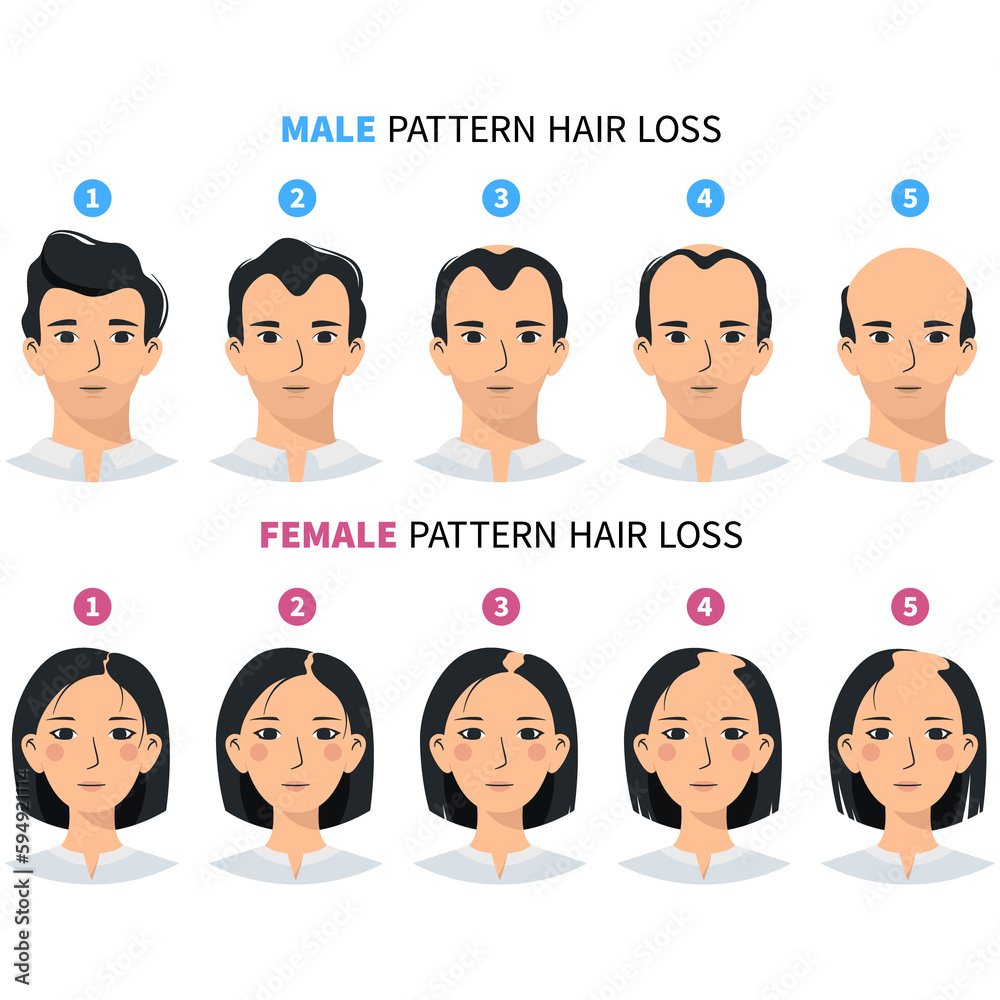 Hair loss stages, androgenetic alopecia male and female pattern. Steps ...
