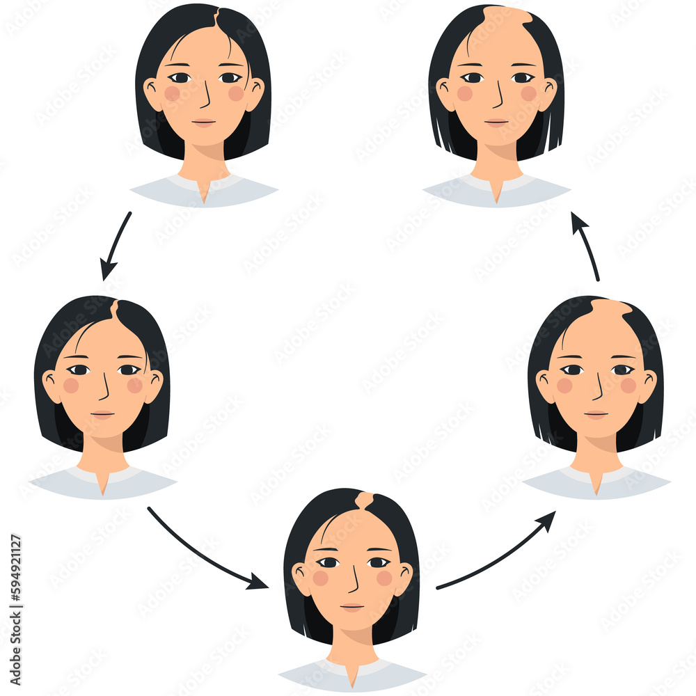 Female androgenetic alopecia, hair loss stages, steps of baldness flat ...