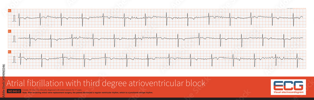 Cardiac surgery is one of the common causes of iatrogenic ...