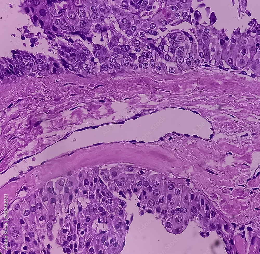 Nodular cystic Hidradenoma. Clear cell hidradenoma, nodular hidradenoma ...