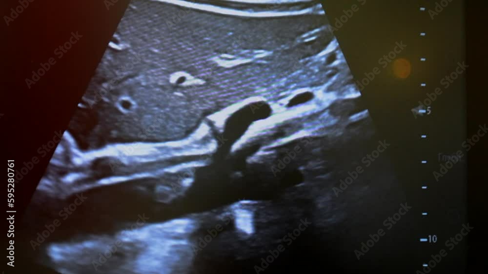 Ultrasound on monitor. Ultrasound image on computer monitor screen ...