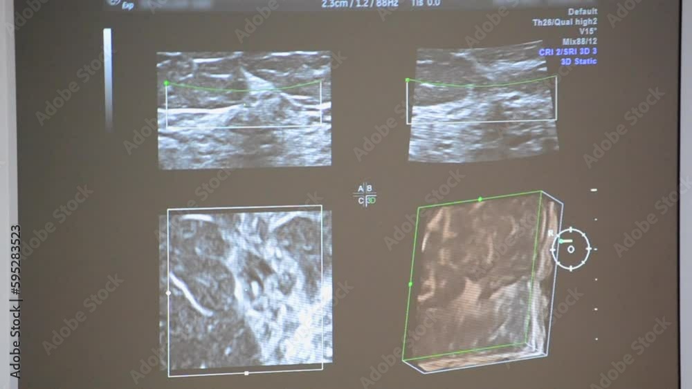 Ultrasound on monitor. Ultrasound image on computer monitor screen ...