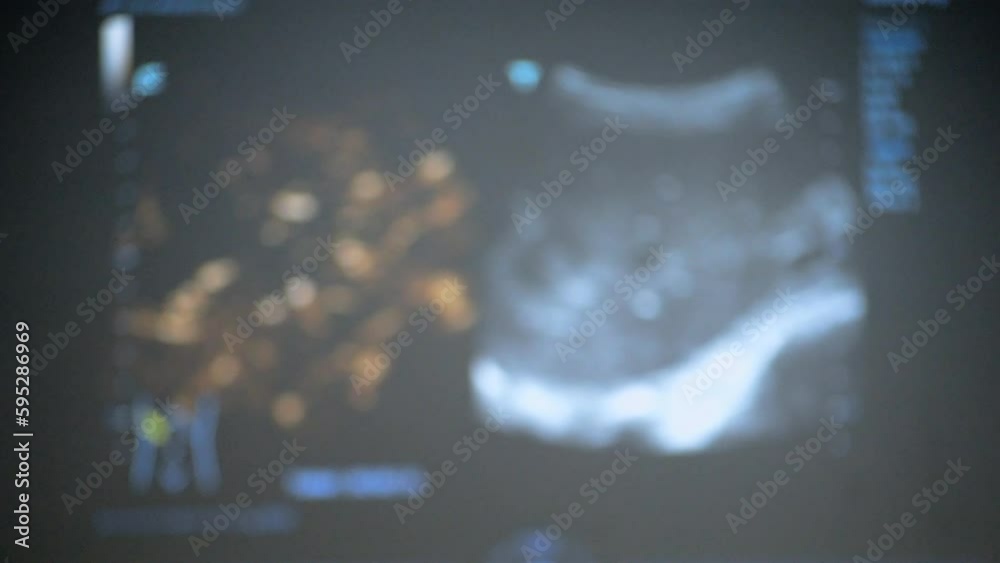 Blurred background. Utrasound image on monitor. Ultrasound Scan display ...
