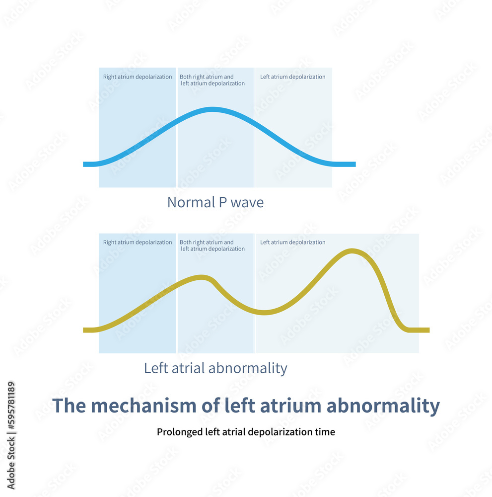 When the left atrium is diseased, the depolarization time of the left ...