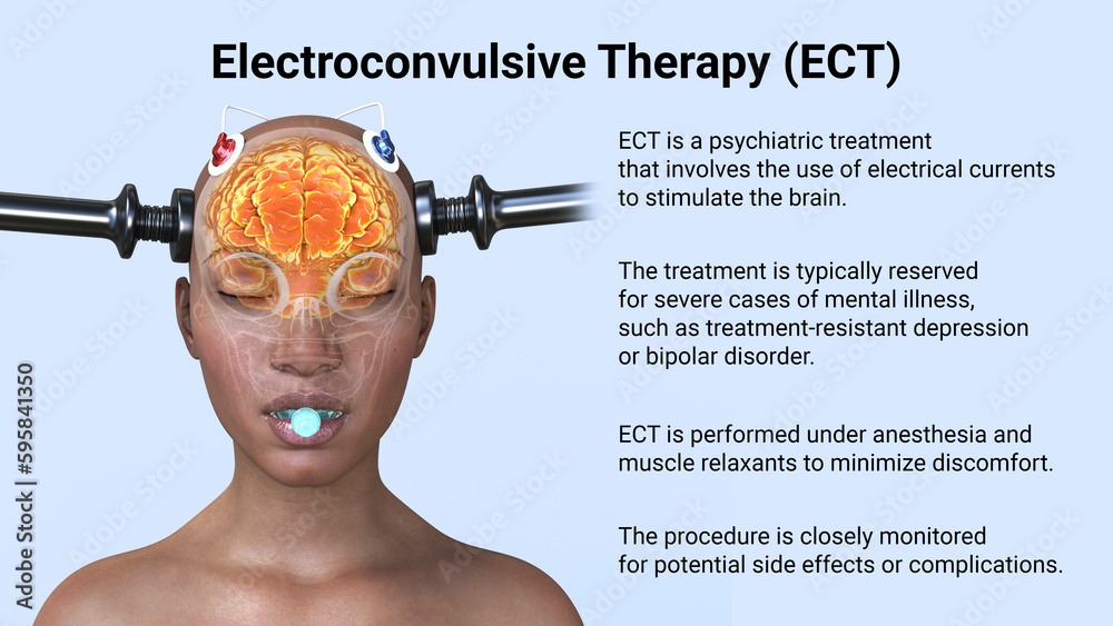 Electroconvulsive therapy, ECT, a treatment involving the use of ...